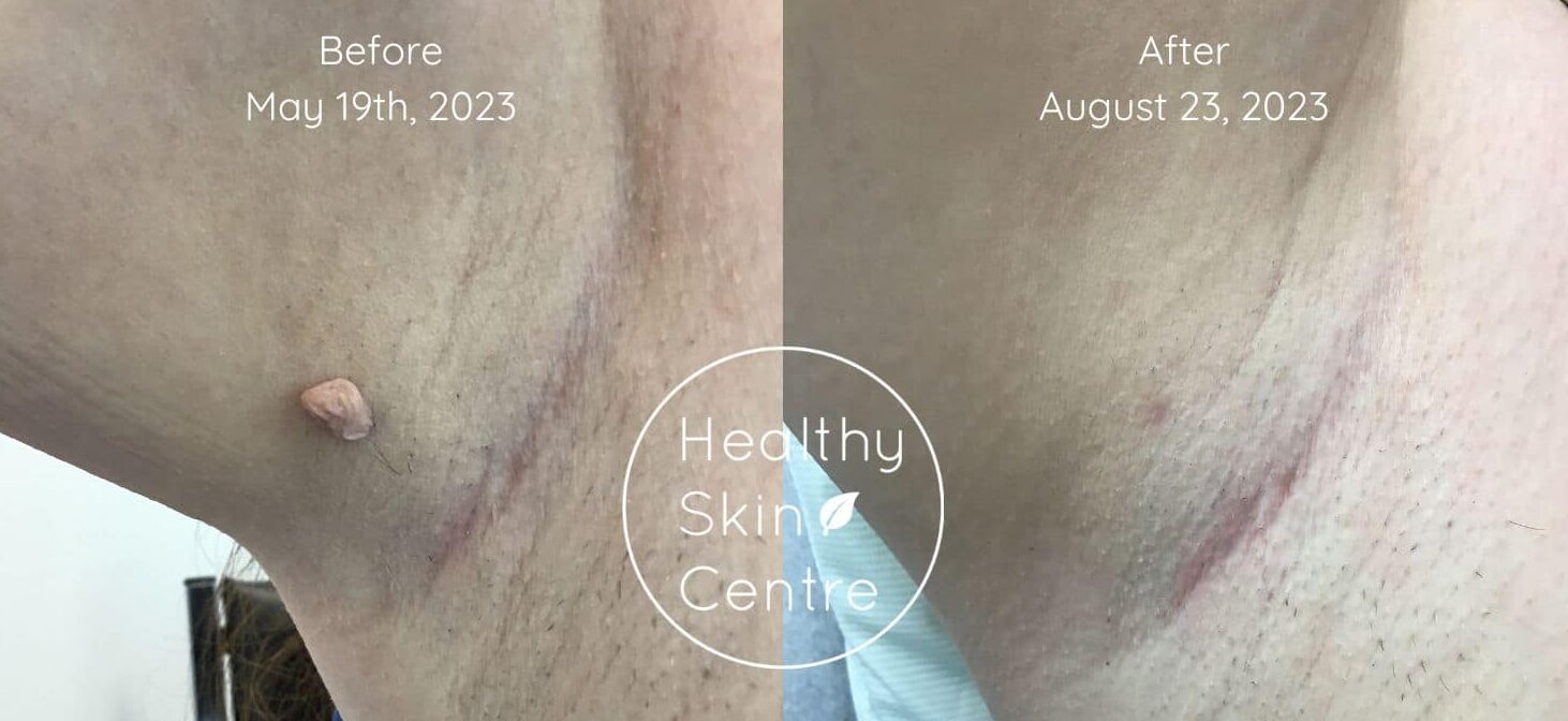 Mole & Skin Tag Removal in New Westminster | Healthy Skin Centre